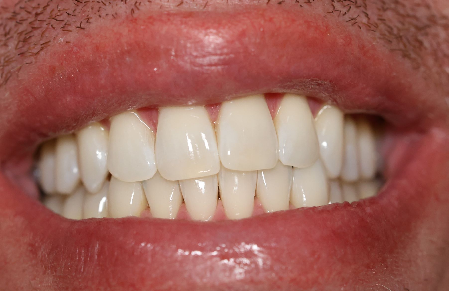 Teeth Cleaning & Whitening in West Hollywood | The Gleamery