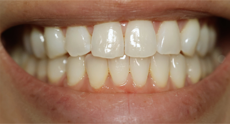 The Gleamery | Teeth Cleanings & whitenings made simple (and better).