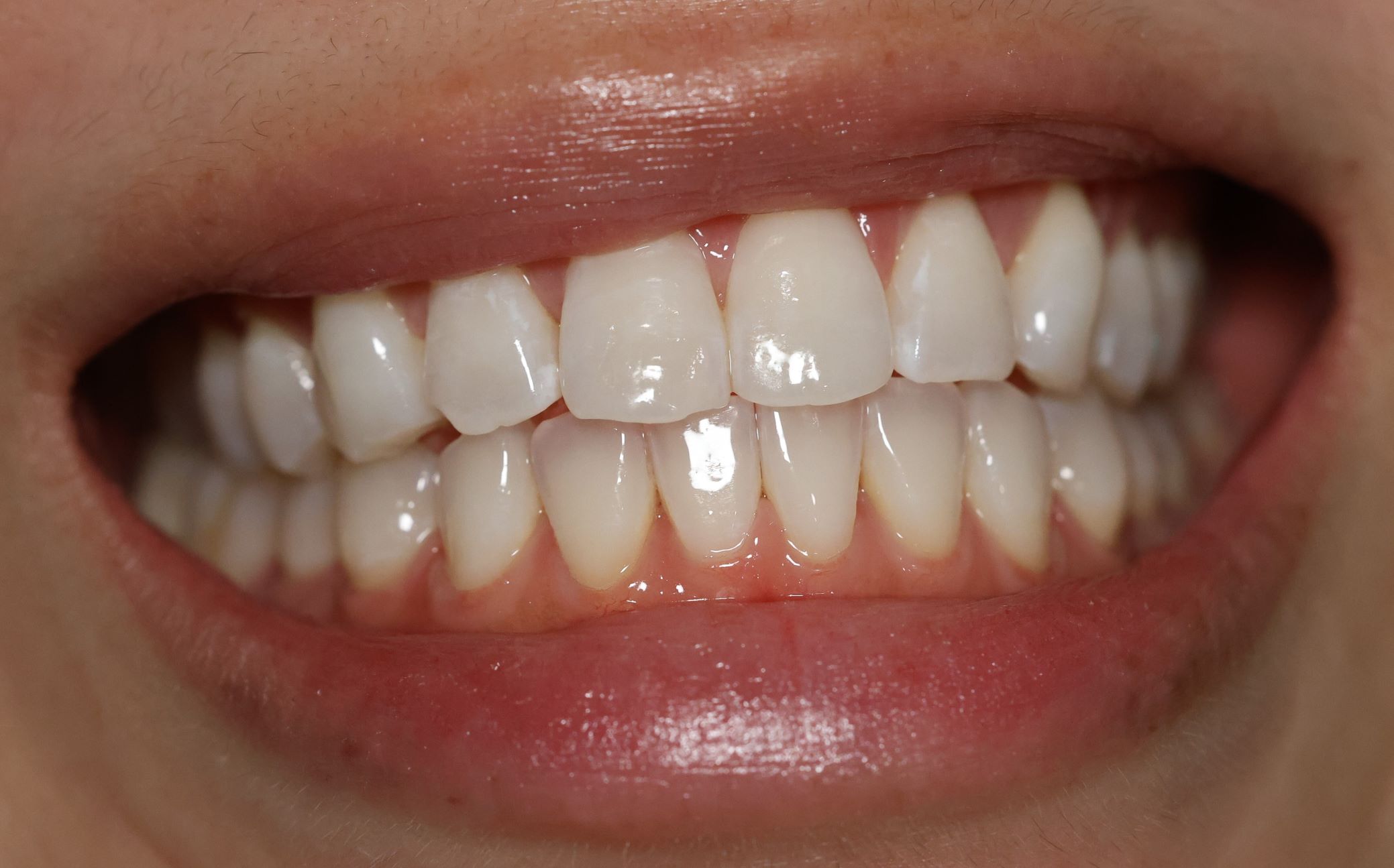 The Gleamery | Teeth Cleanings & whitenings made simple (and better).