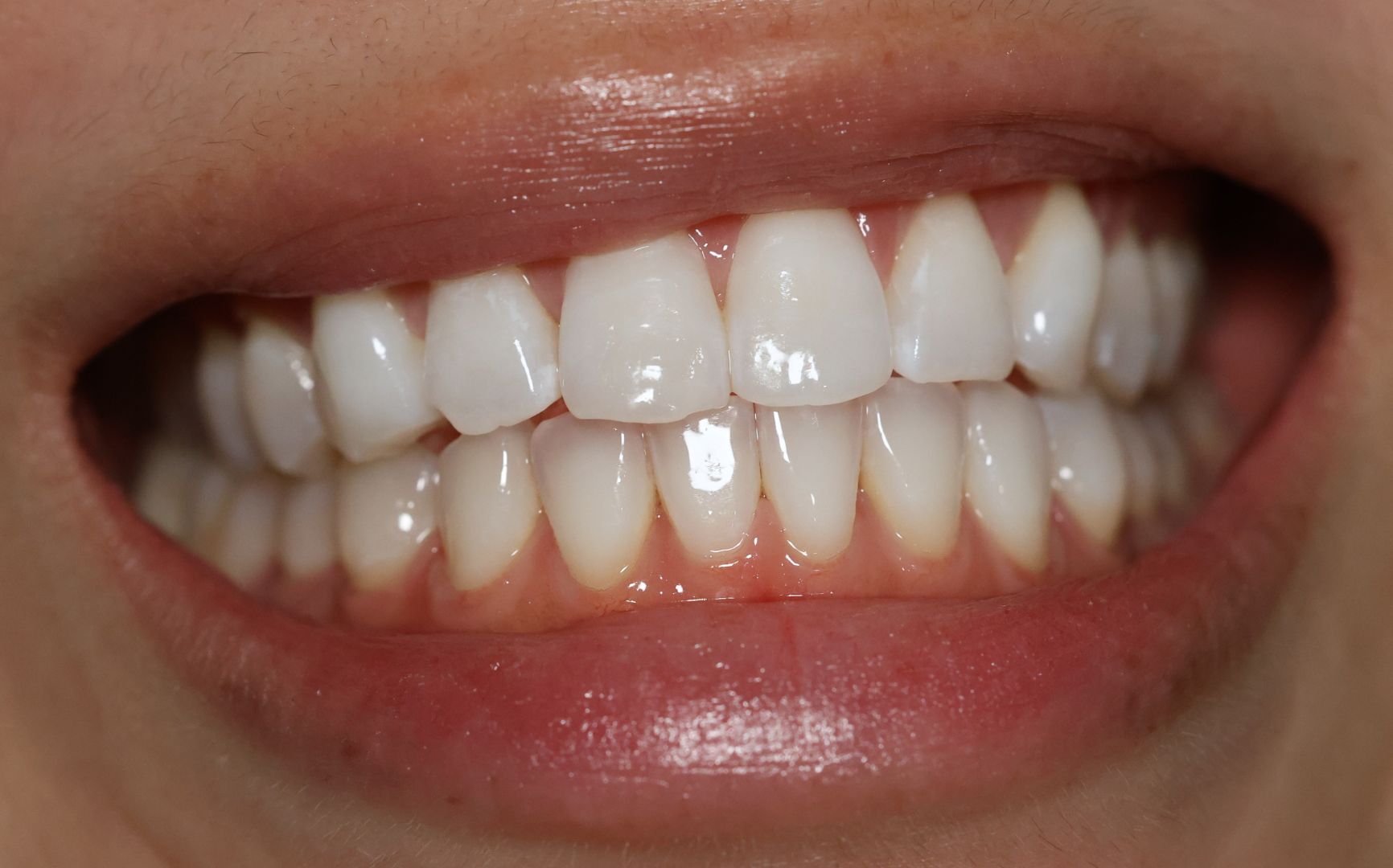 Professional Teeth Whitening in Los Angeles | The Gleamery