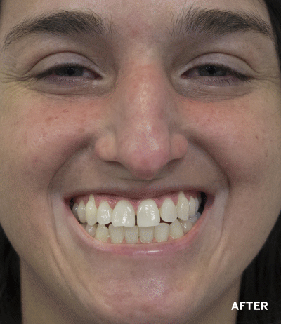 Teeth Whitening Before and After | Supersmile